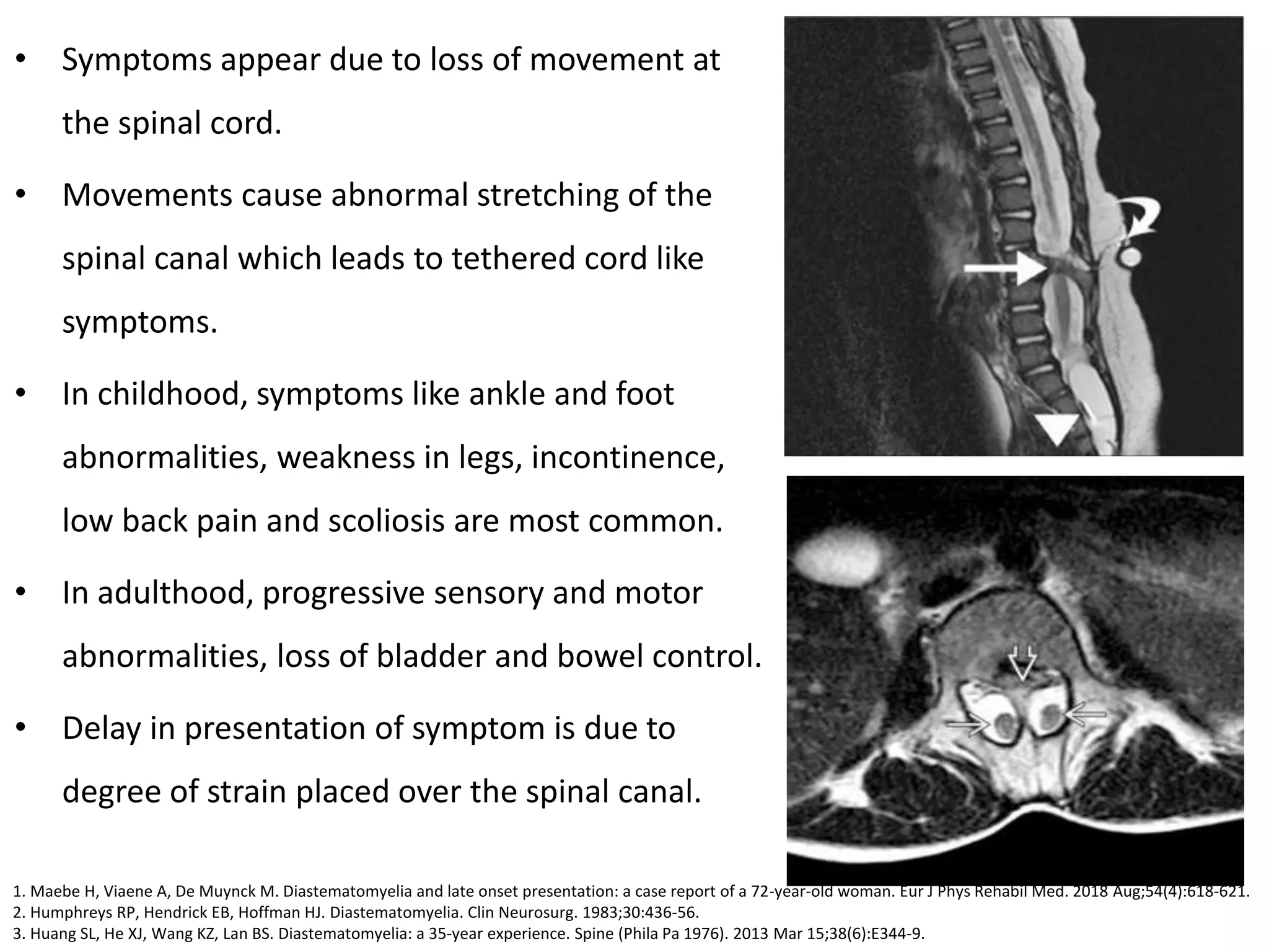 Congenital diseases causing Spinal Cord Compression | PPTX