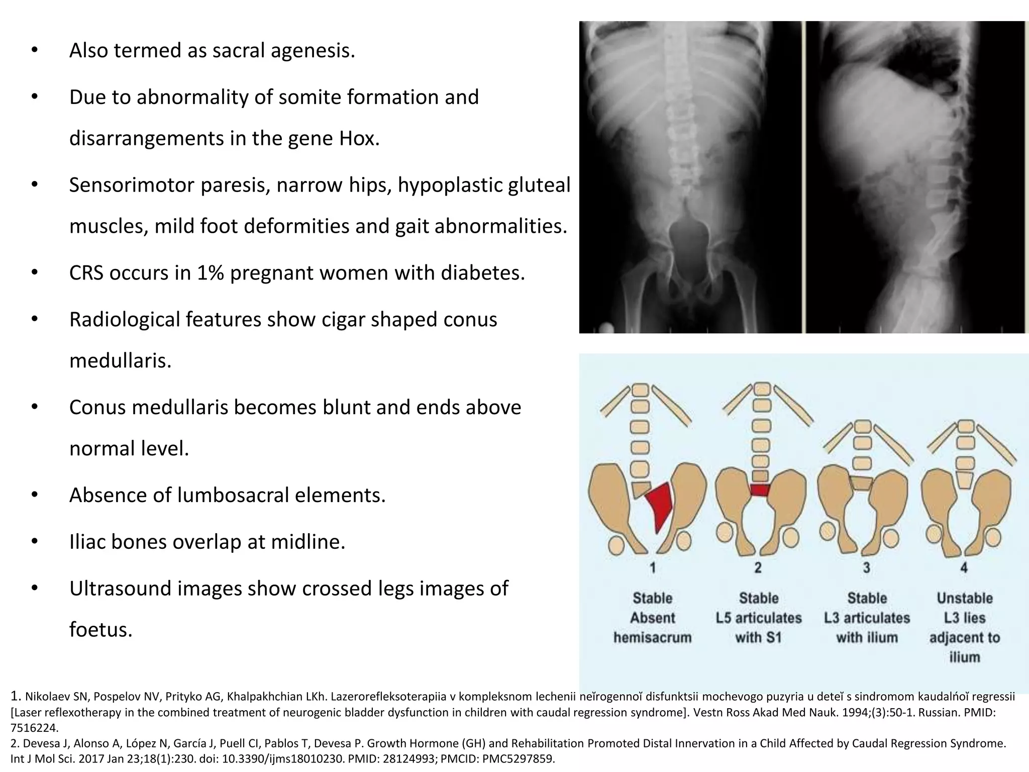 Congenital diseases causing Spinal Cord Compression | PPTX