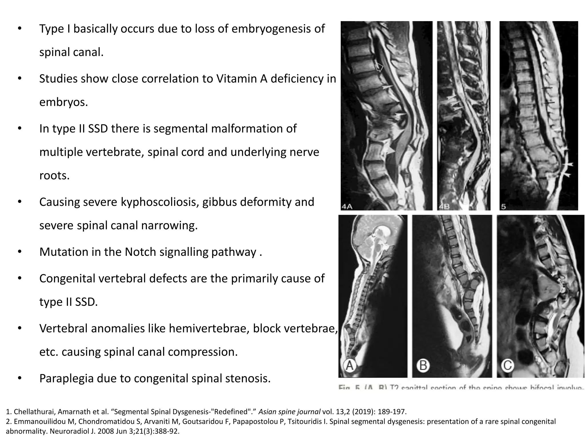 Congenital diseases causing Spinal Cord Compression | PPTX