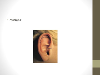 CONGENITAL DISEASES OF THE EAR.pptx