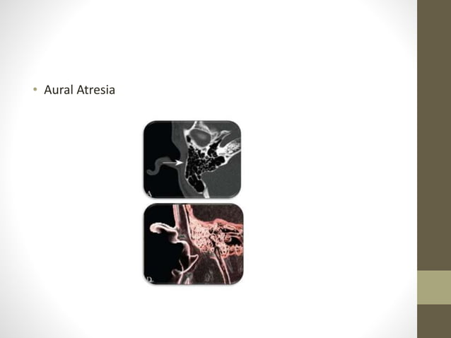 CONGENITAL DISEASES OF THE EAR.pptx