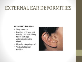 CONGENITAL DISEASES OF THE EAR.pptx