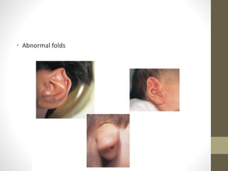 CONGENITAL DISEASES OF THE EAR.pptx