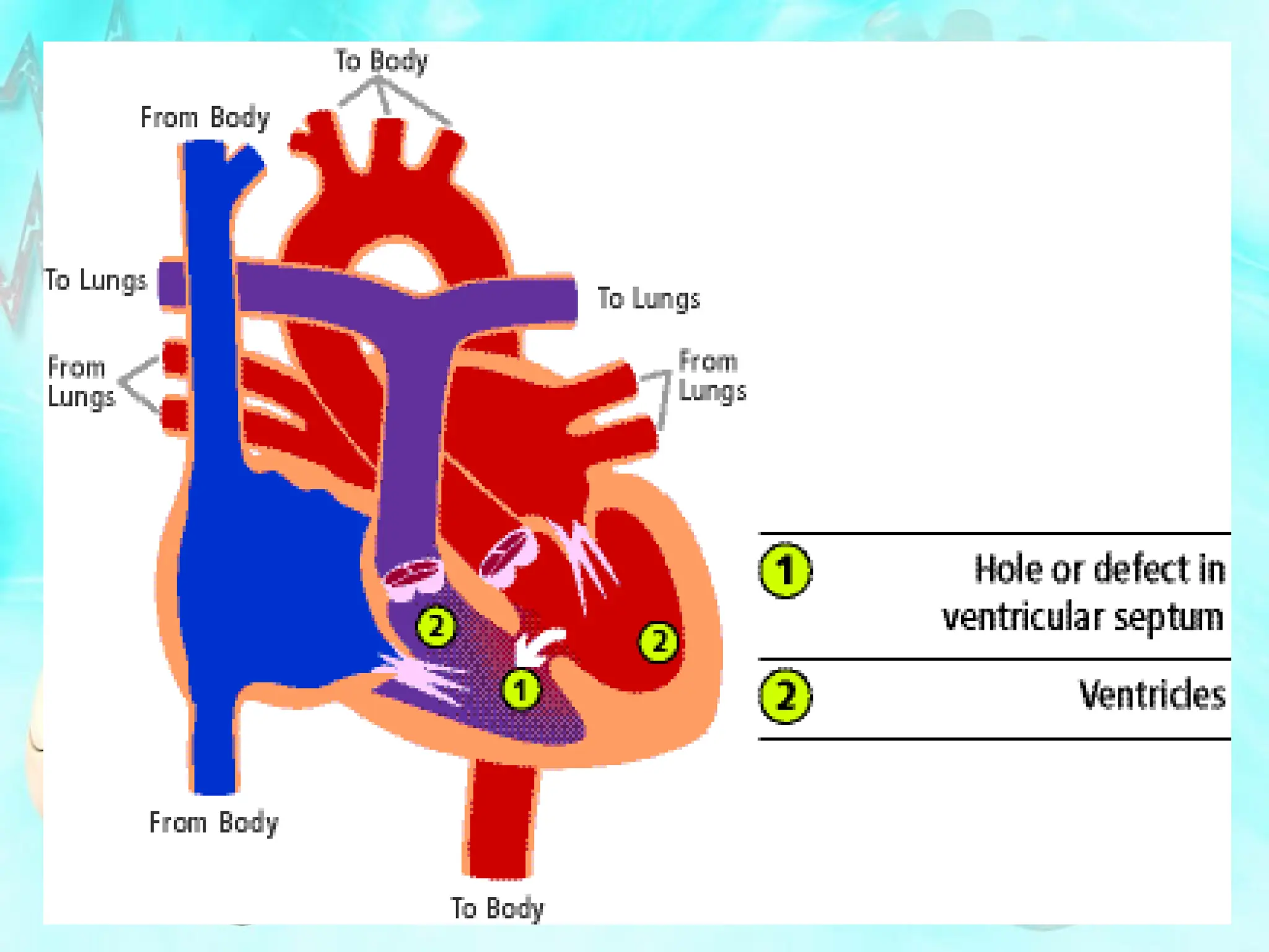 Congenital Diseases of the Heart in Children.pptx