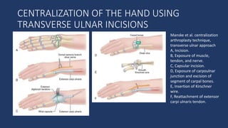 upper limb congenital anomalies | PPTX