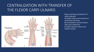 upper limb congenital anomalies | PPTX