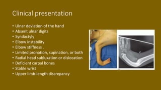 upper limb congenital anomalies | PPTX