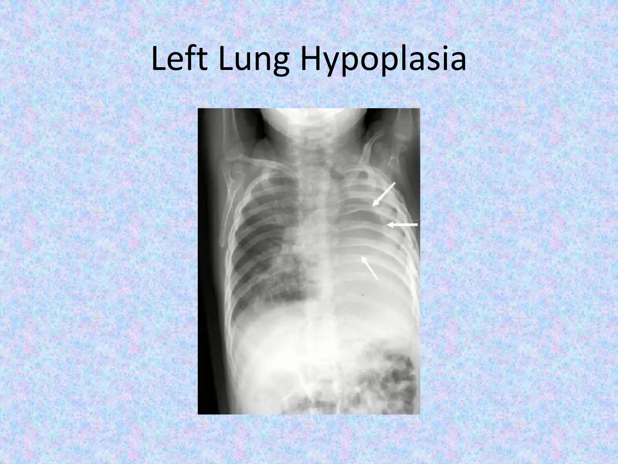 Congenital Disorder of lung | PPTX