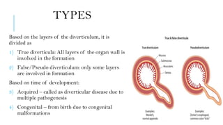 Congenital diverticula .pptx