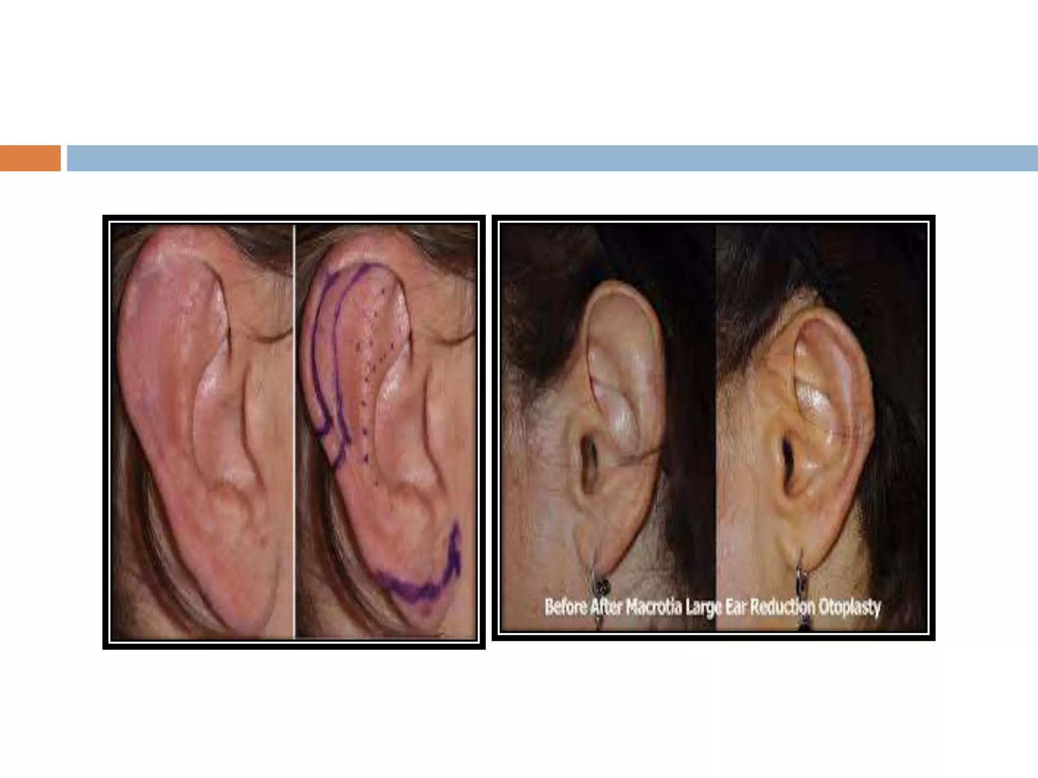 Congenital ear deformities | PPTX