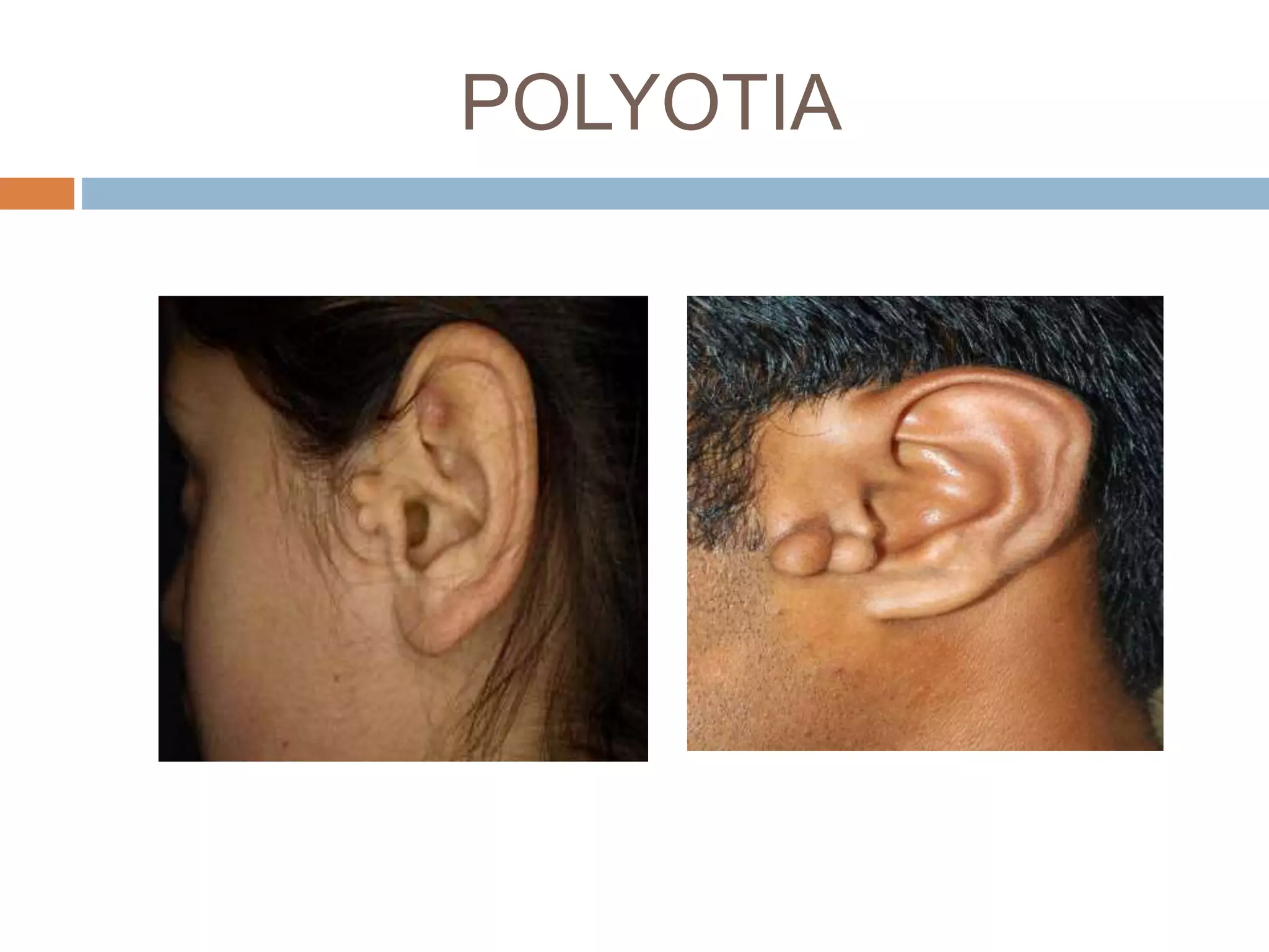 Congenital ear deformities | PPTX