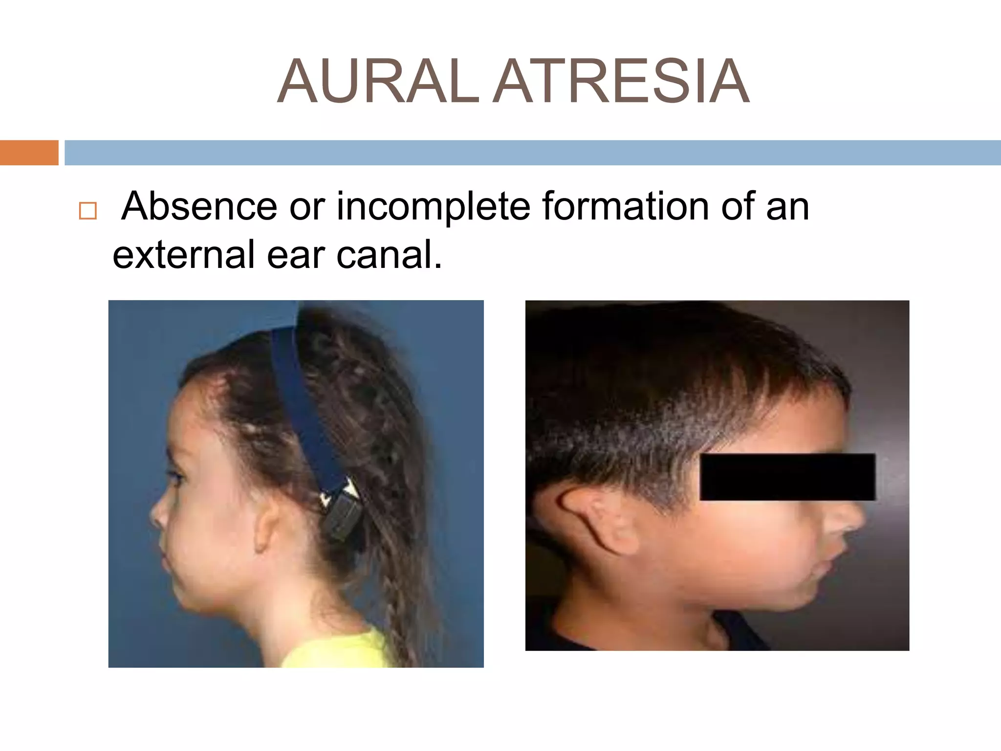 Congenital ear deformities | PPTX