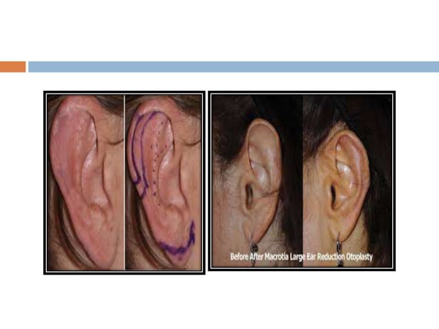 Congenital ear deformities | PPTX | Pregnancy | Reproductive Health