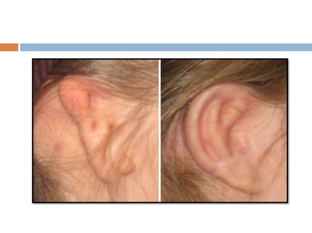 Congenital ear deformities | PPTX | Pregnancy | Reproductive Health