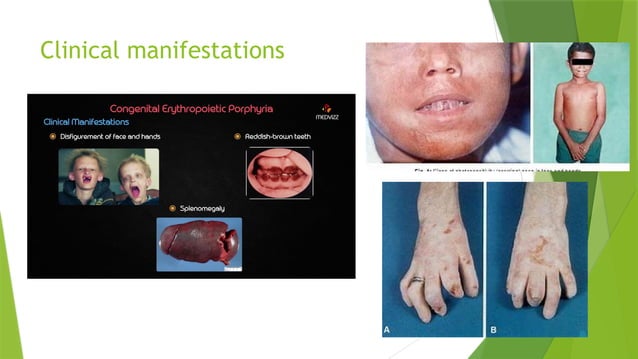 CONGENITAL ERYTHROPOETIC PORPHYRIA.pptx