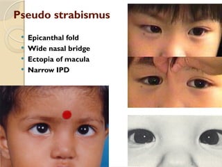 Congenital Esotropia diagnosis and management.pptx