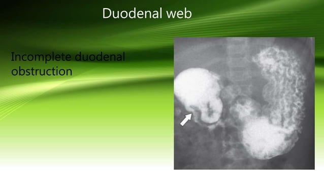 congenitalgastrointestinalanomalies-161121183124.pptx