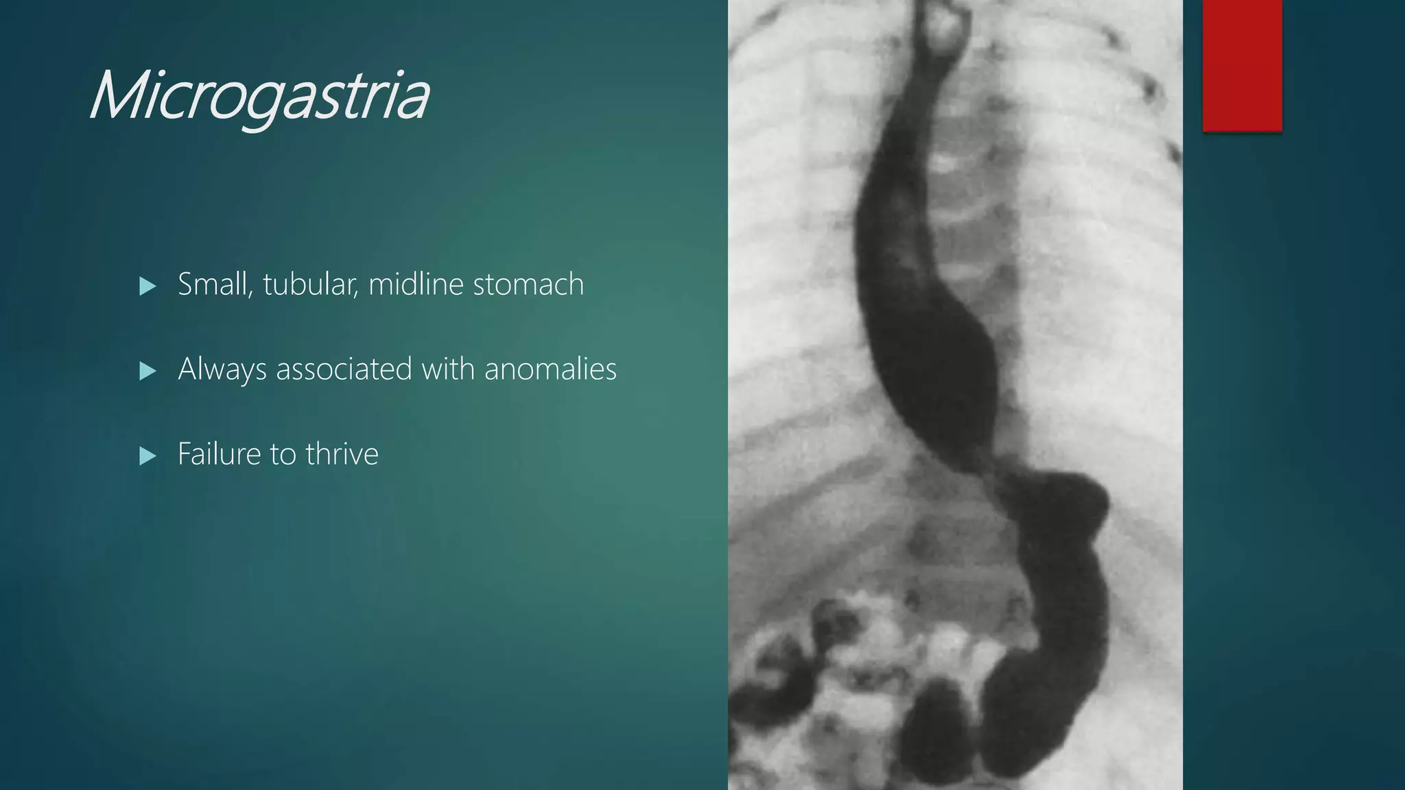 Congenital gastrointestinal anomalies | PPTX