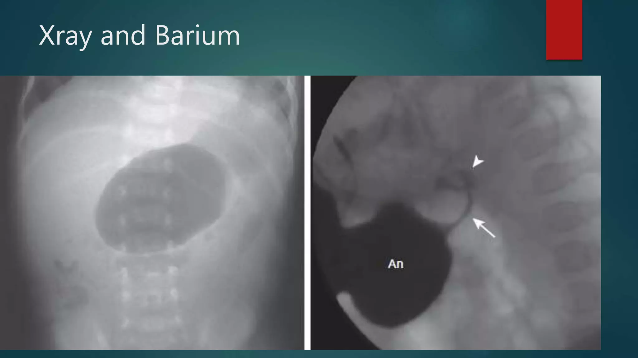 Congenital gastrointestinal anomalies | PPTX