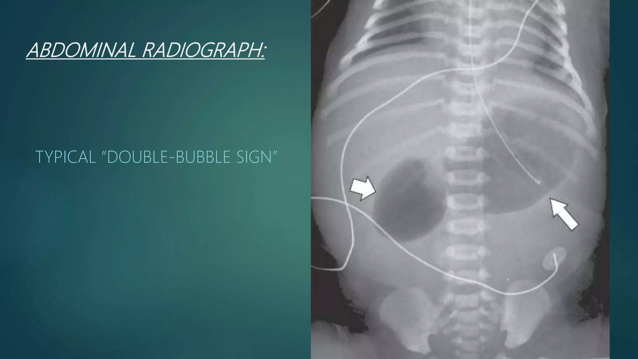 Congenital gastrointestinal anomalies | PPTX