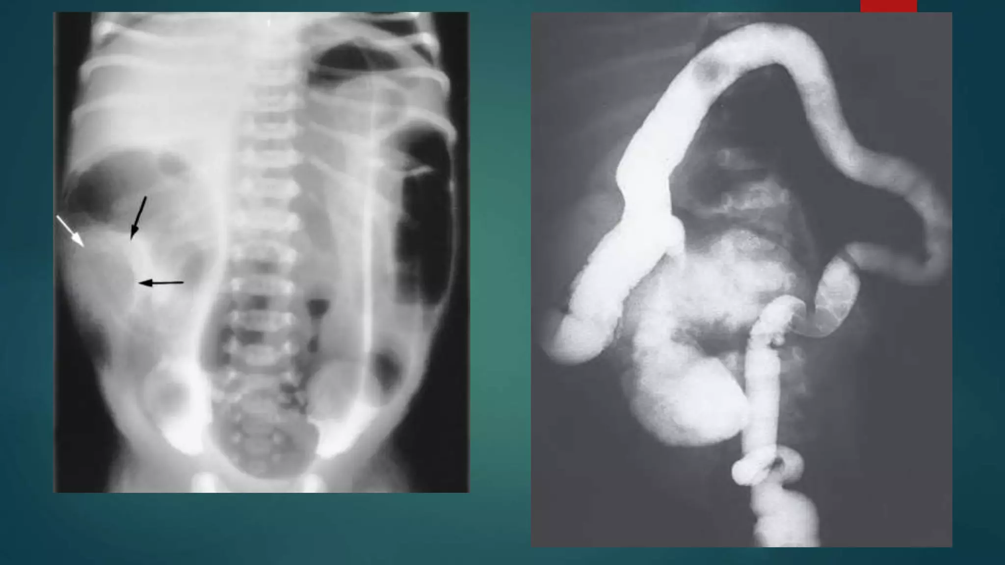 Congenital gastrointestinal anomalies | PPTX