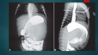 Congenital gastrointestinal anomalies | PPTX