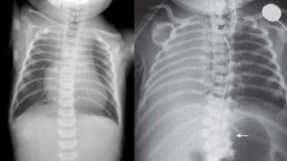 Congenital gastrointestinal anomalies | PPTX