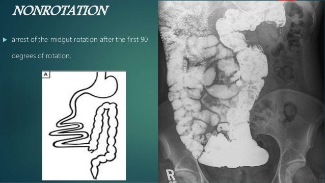 Congenital Gastrointestinal Anomalies