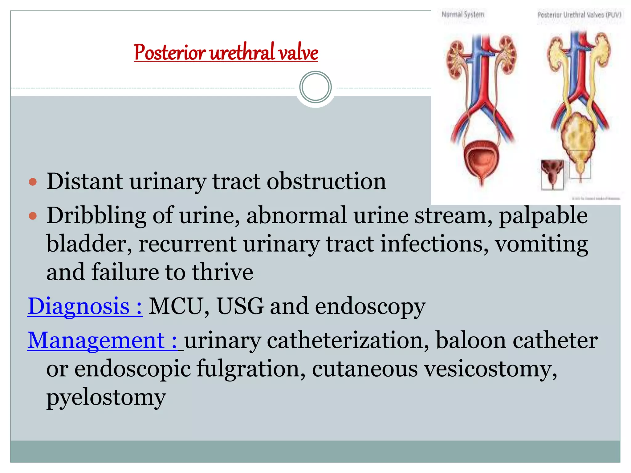 Congenital genito urinary disorders | PPTX