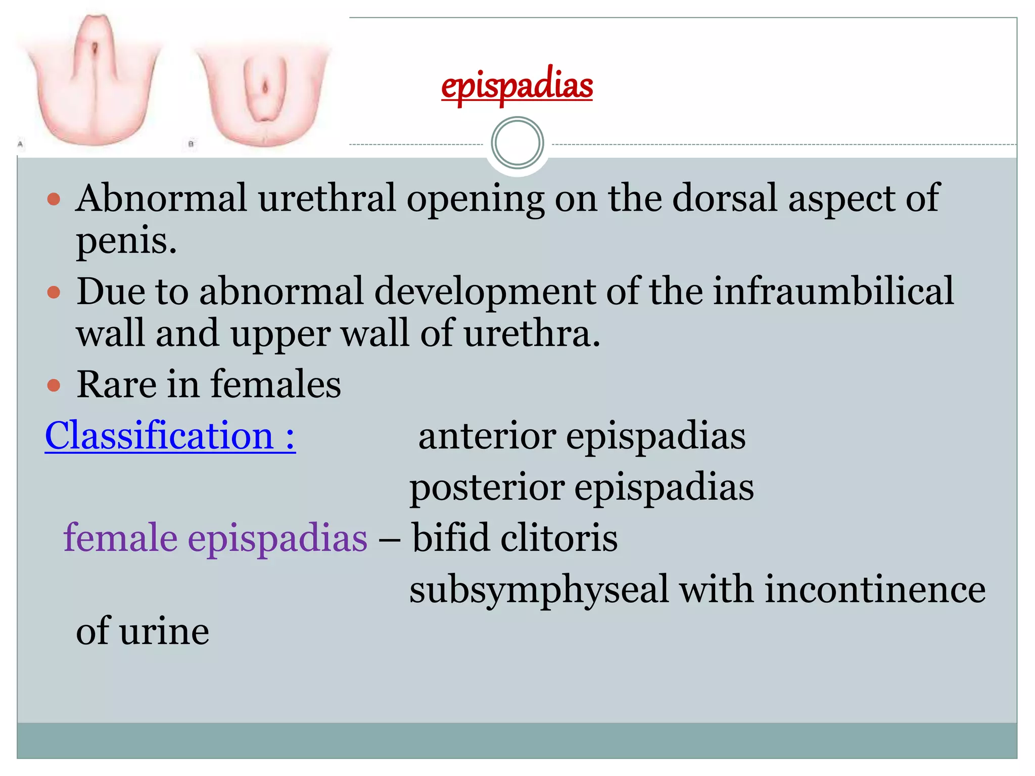 Congenital genito urinary disorders | PPTX
