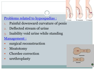 Congenital genito urinary disorders | PPTX