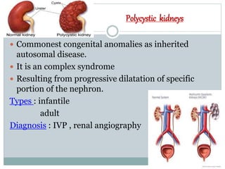 Congenital genito urinary disorders | PPTX