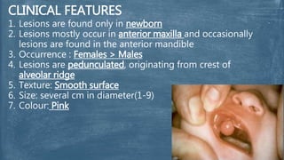 Congenital Epulis