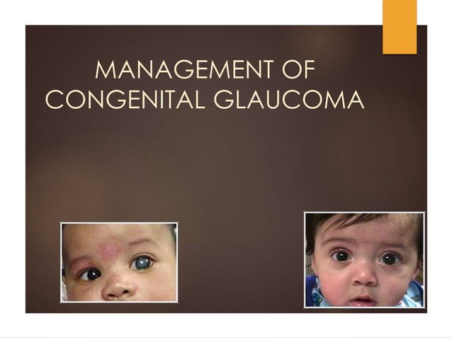 Congenital glaucoma | PPT