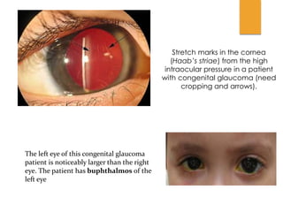 Congenital glaucoma | PPTX