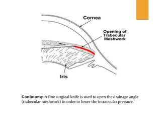 Congenital glaucoma | PPTX