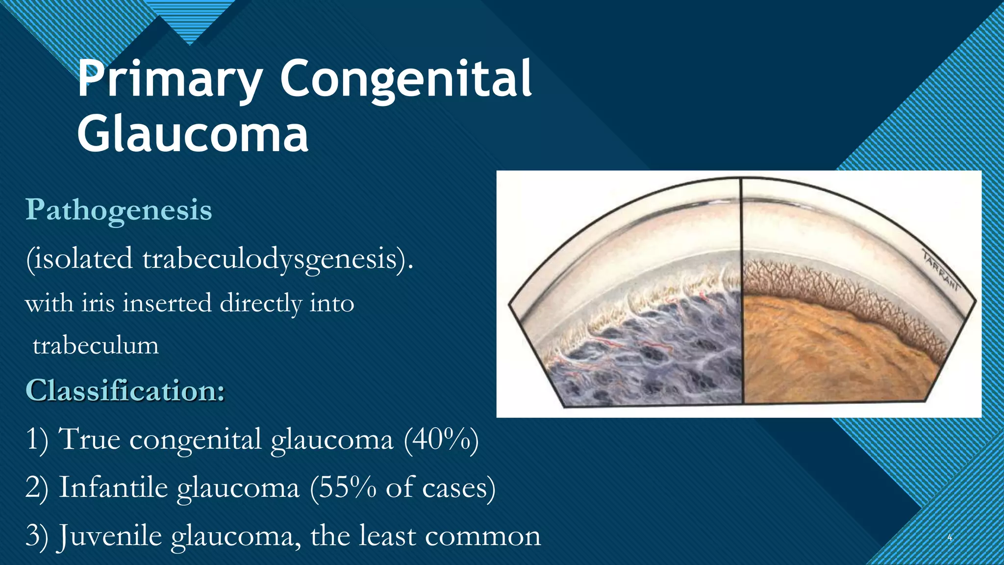 Congenital glaucoma | PPTX