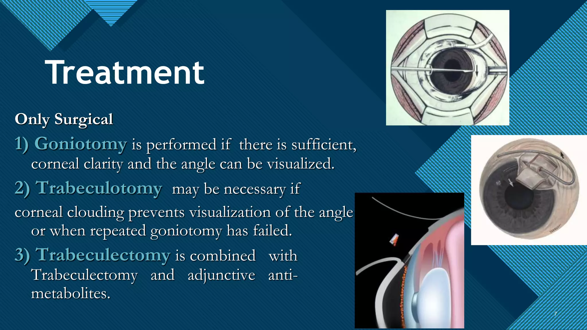 Congenital glaucoma | PPTX