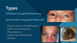 Congenital glaucoma | PPTX
