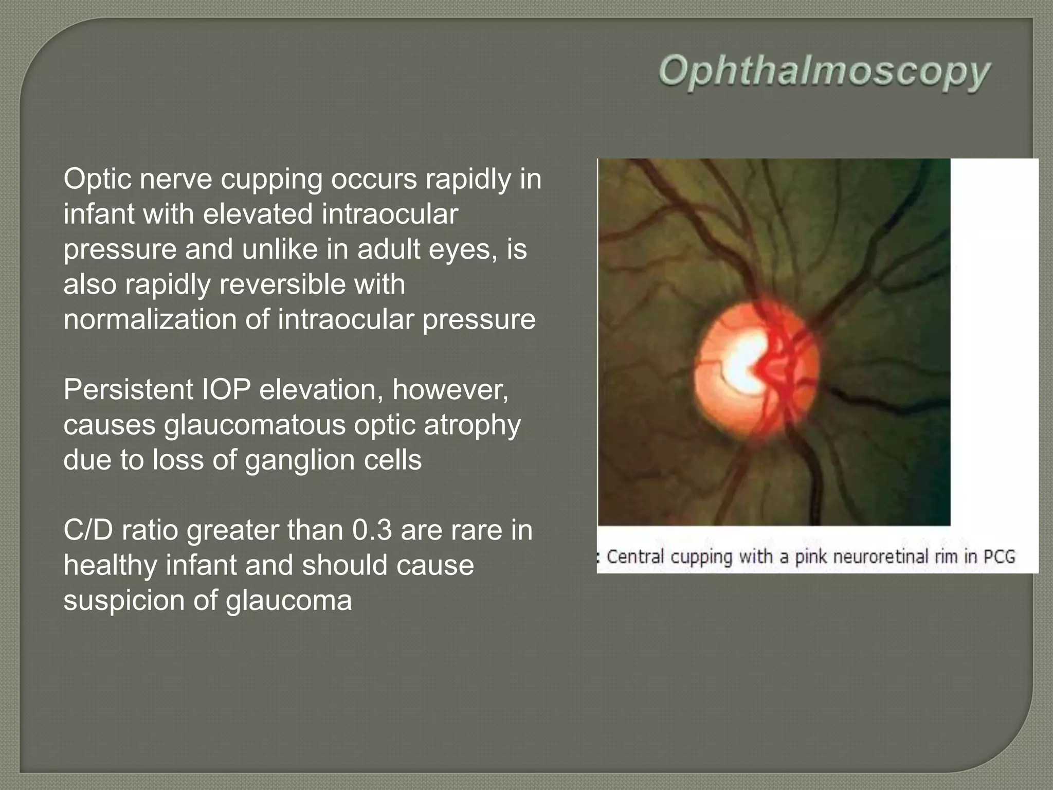 Congenital glaucoma.pptx