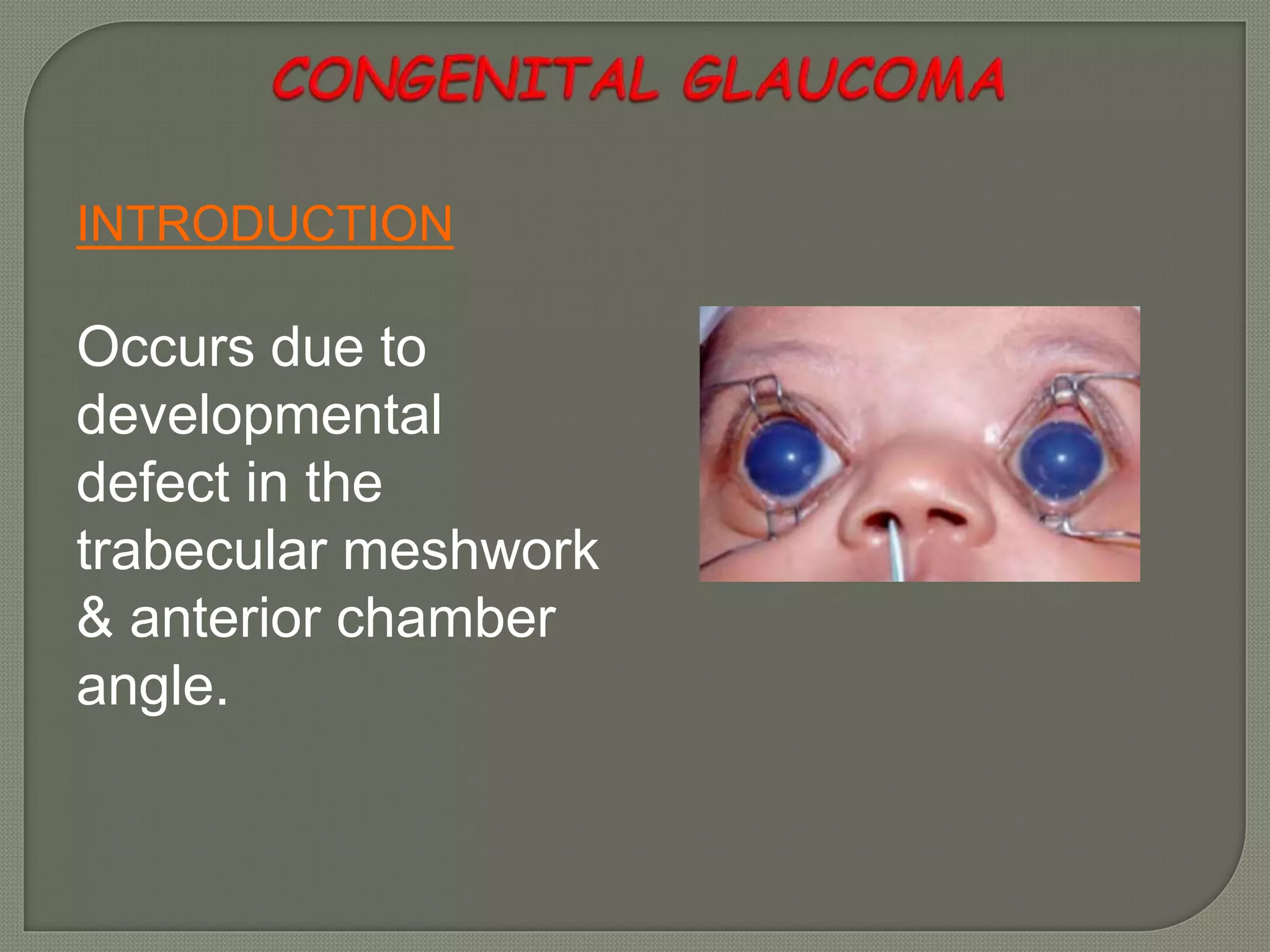 Congenital glaucoma.pptx