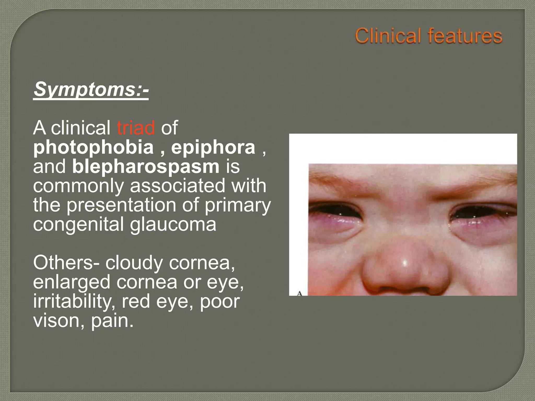 Congenital glaucoma.pptx