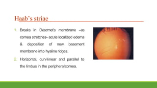 Congenital glaucoma -Evaluation | PPTX