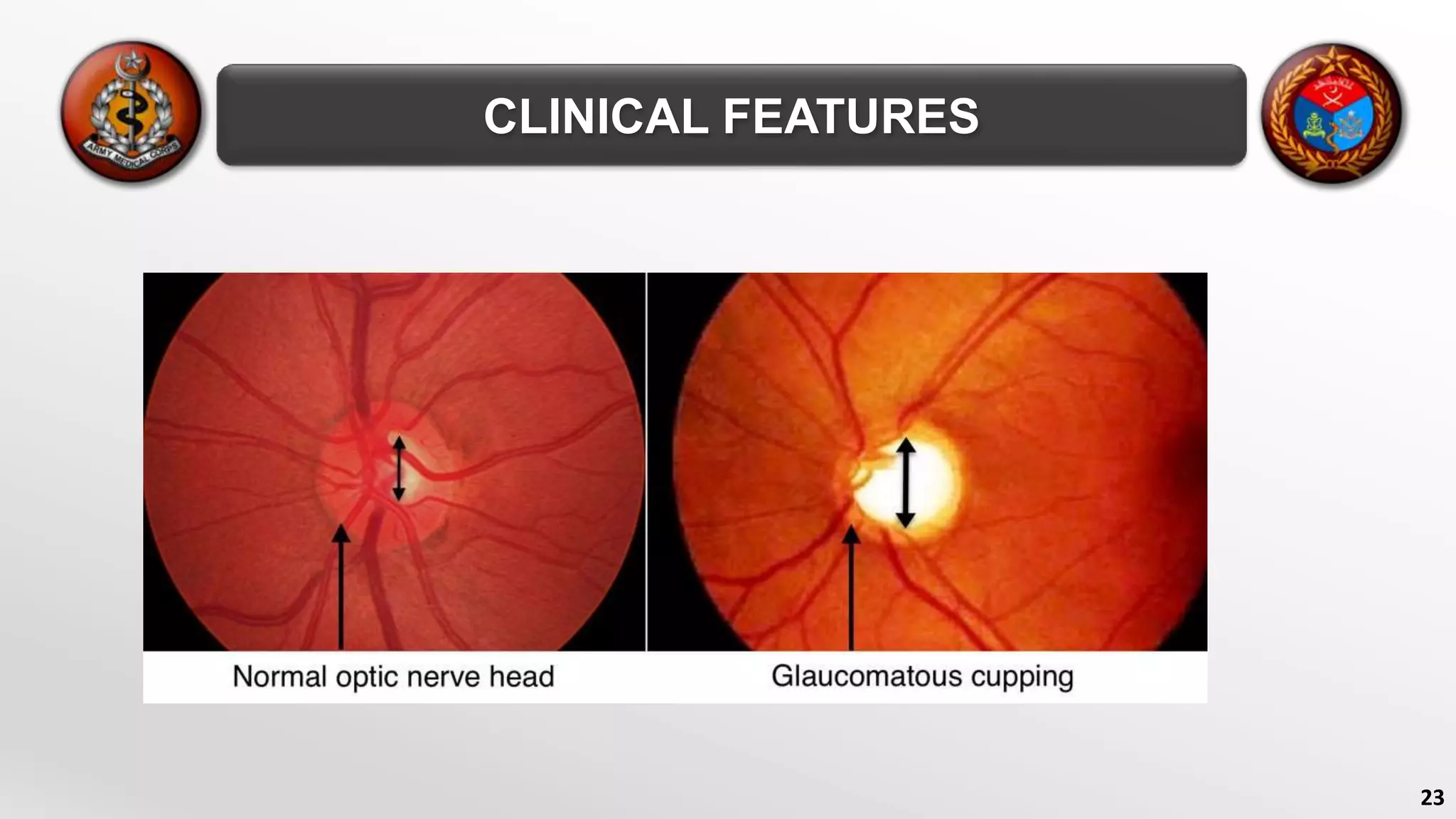 CONGENITAL GLAUCOMA - USMAN.pptx