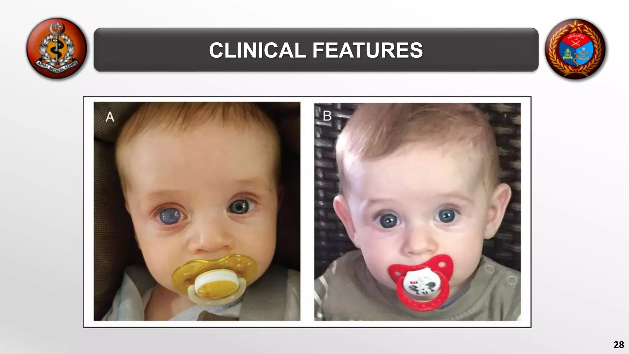 CONGENITAL GLAUCOMA - USMAN.pptx