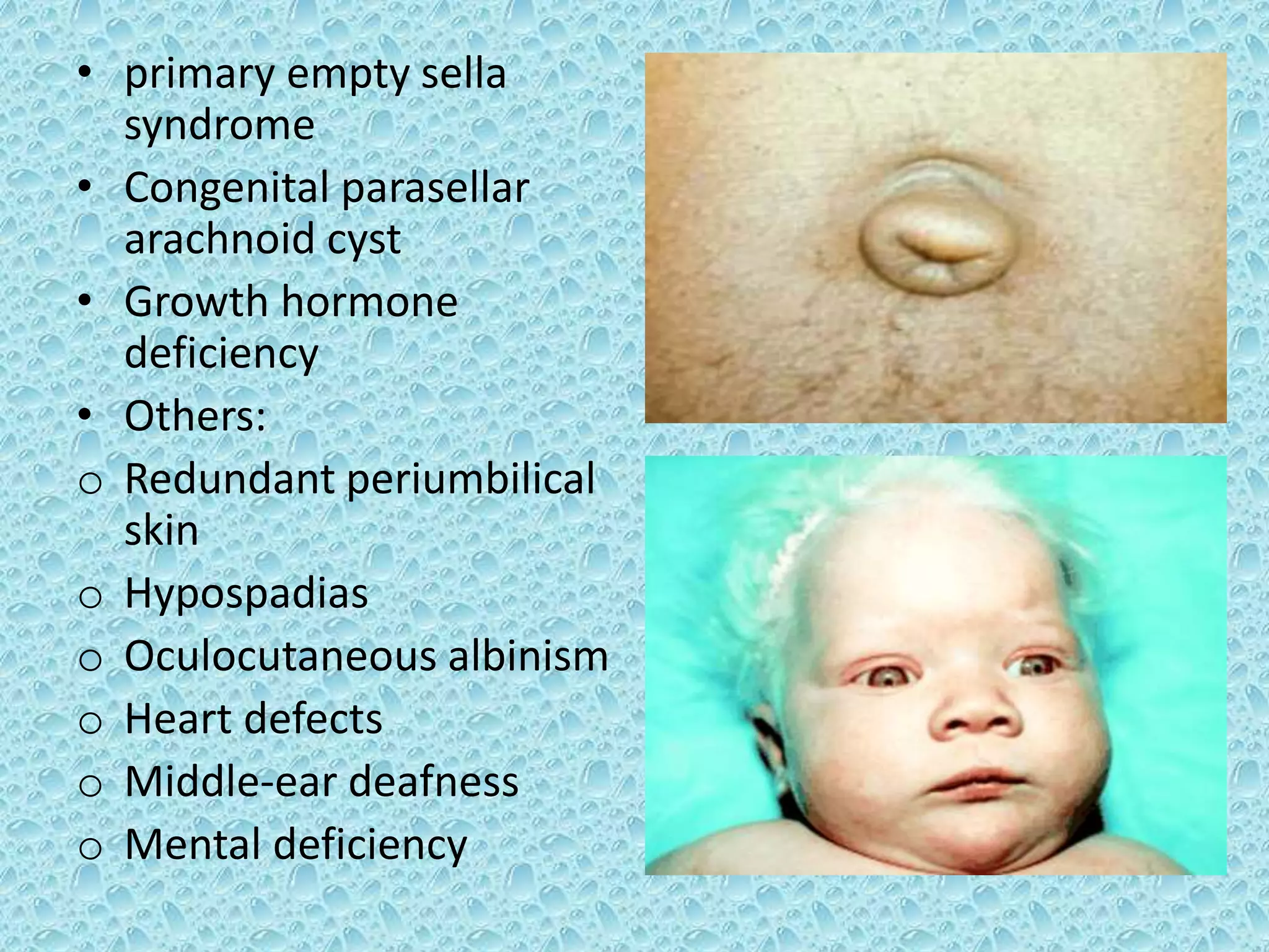 Congenital glaucoma part2; developmental glaucoma | PPTX