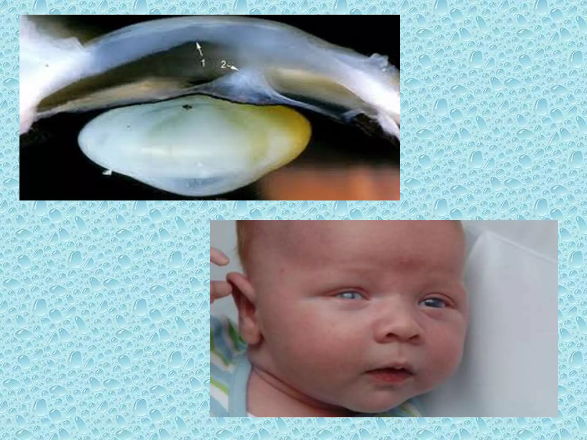 Congenital glaucoma part2; developmental glaucoma | PPTX