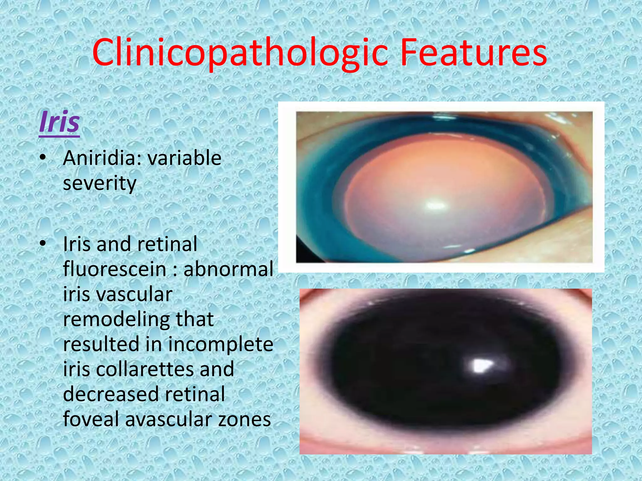 Congenital glaucoma part2; developmental glaucoma | PPTX