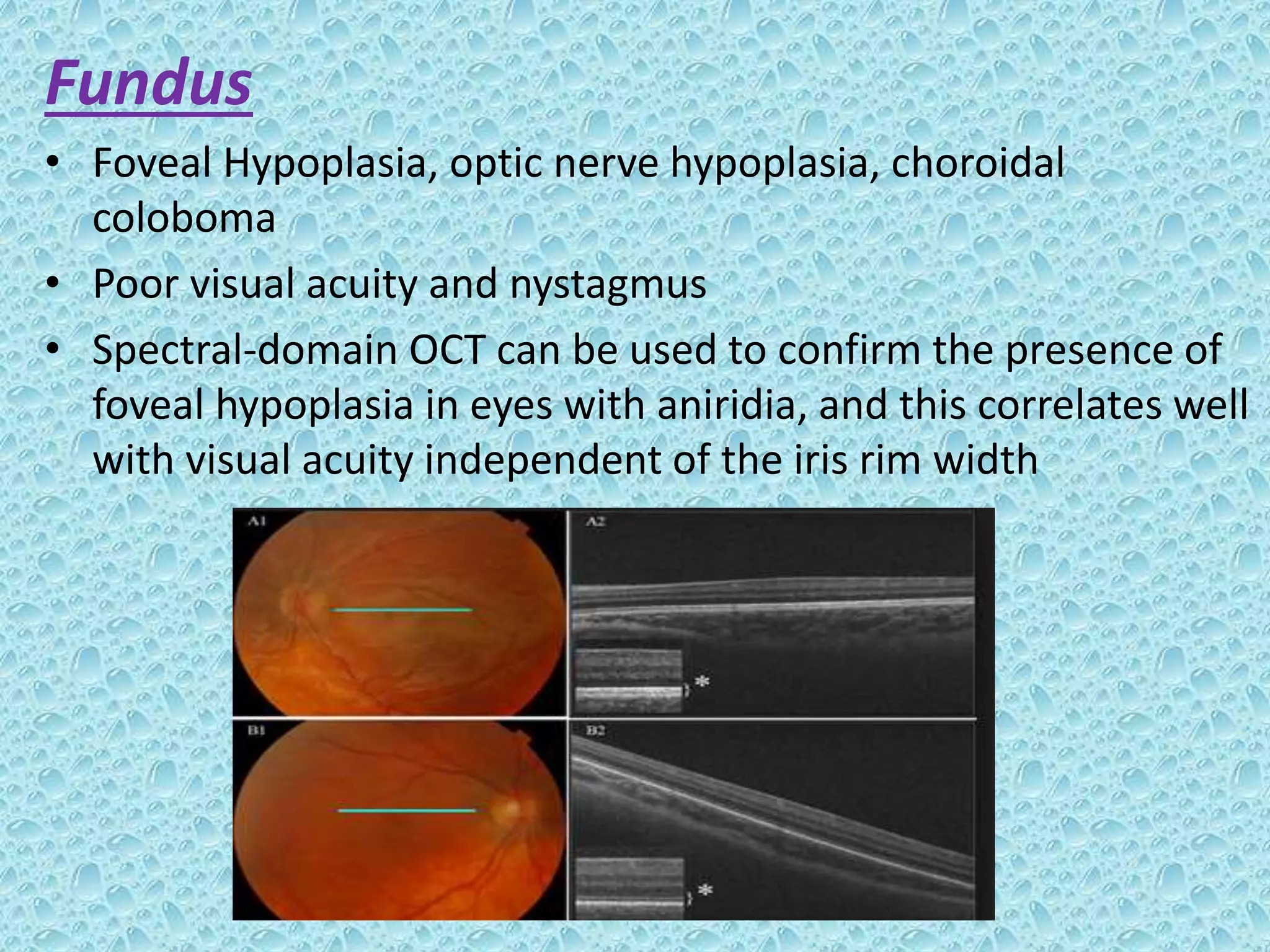 Congenital glaucoma part2; developmental glaucoma | PPTX