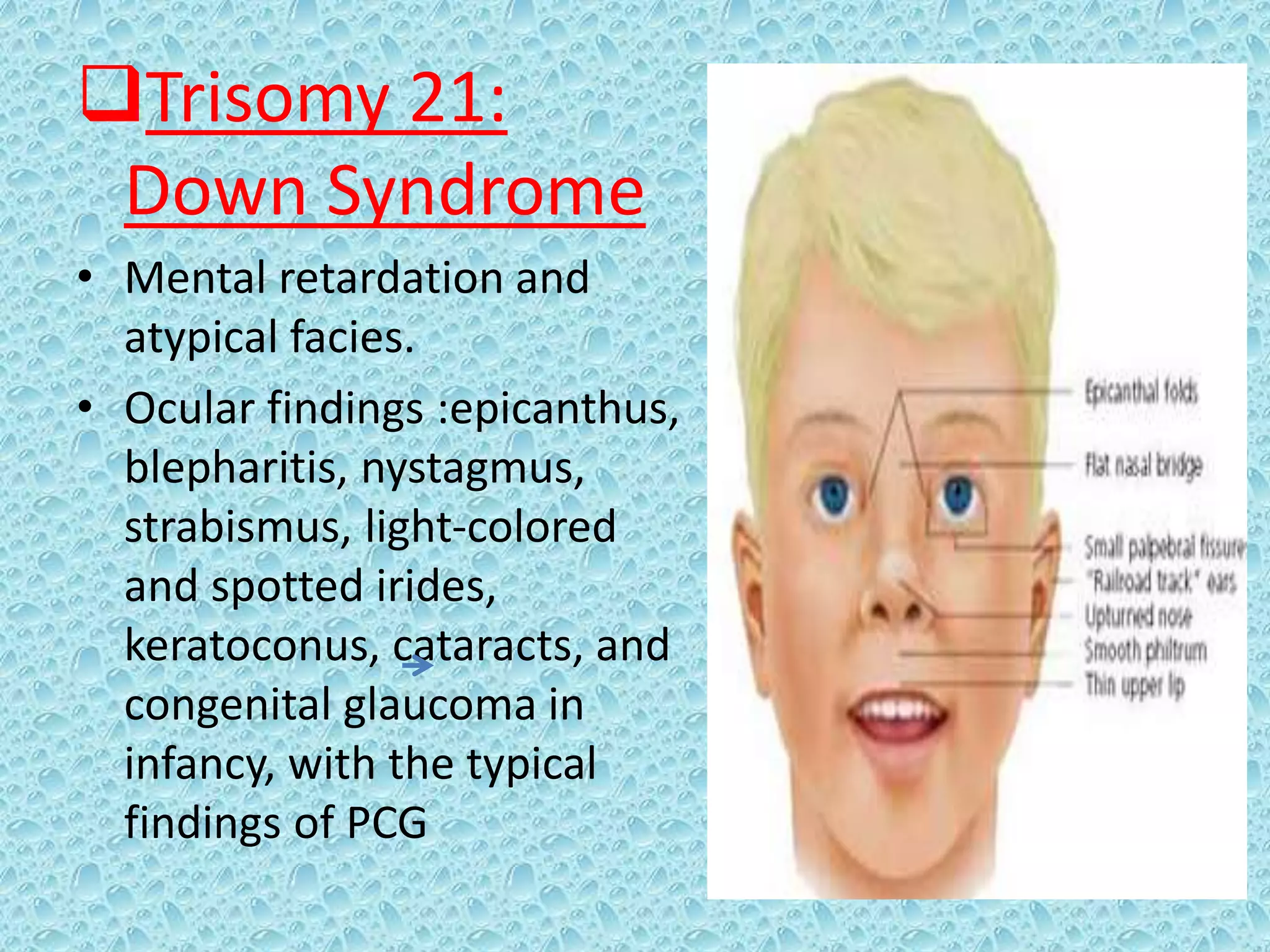 Congenital glaucoma part2; developmental glaucoma | PPTX
